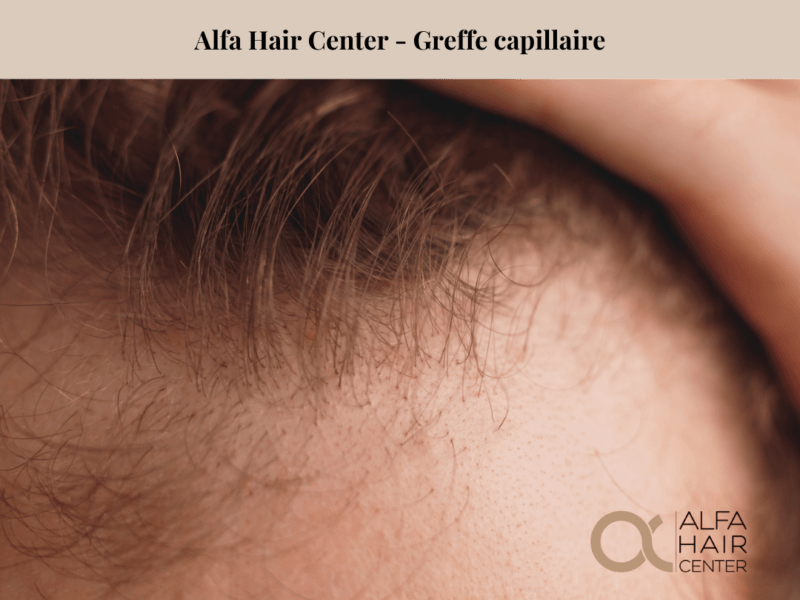 Alfa Hair Center, ça vous parle ? - Alfa Laser Center - Blog