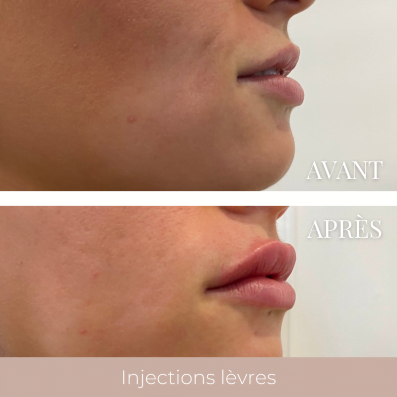 Des lèvres repulpées, naturelles et jolies : ça se passe chez Alfa ...