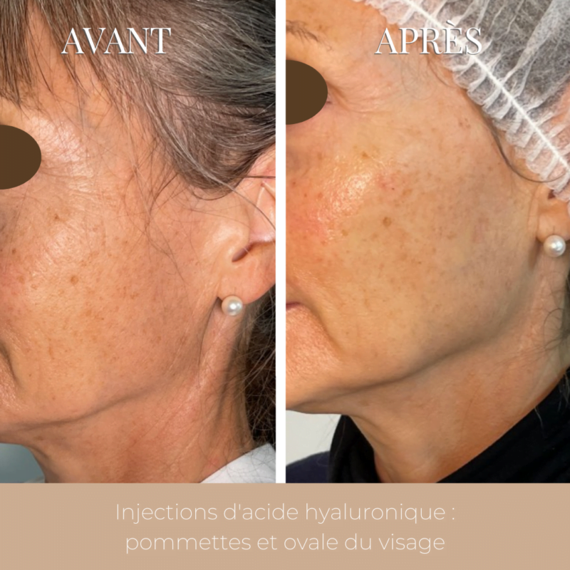 Zoom sur l’acide hyaluronique - Alfa Laser Center - Blog