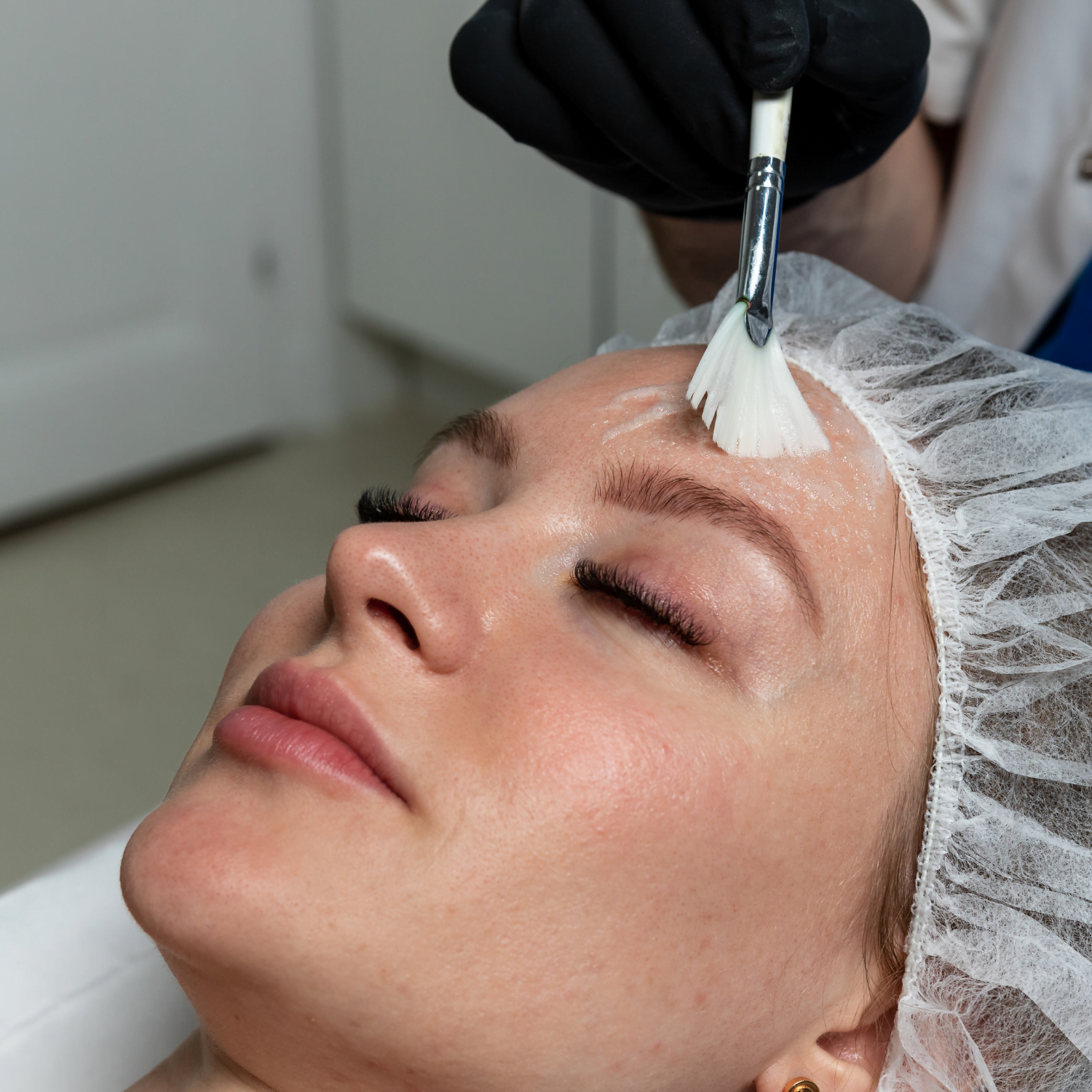 Le traitement de la rosacée - Alfa Laser Center - Blog