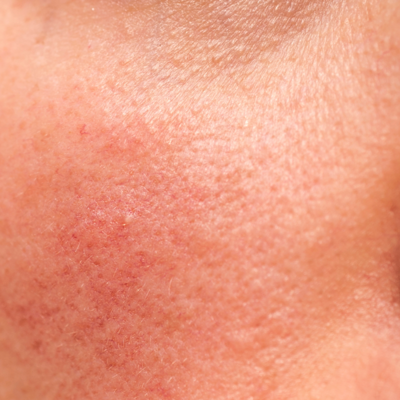 Le traitement de la rosacée - Alfa Laser Center - Blog